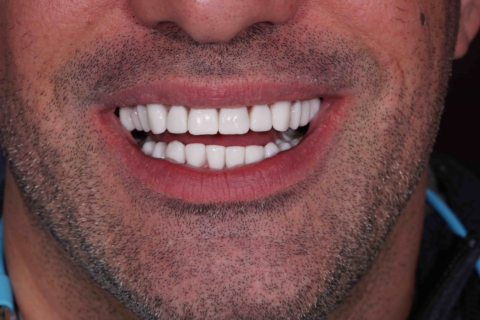 Ultra-thin super bleached composites veneers - Dental Aesthetics