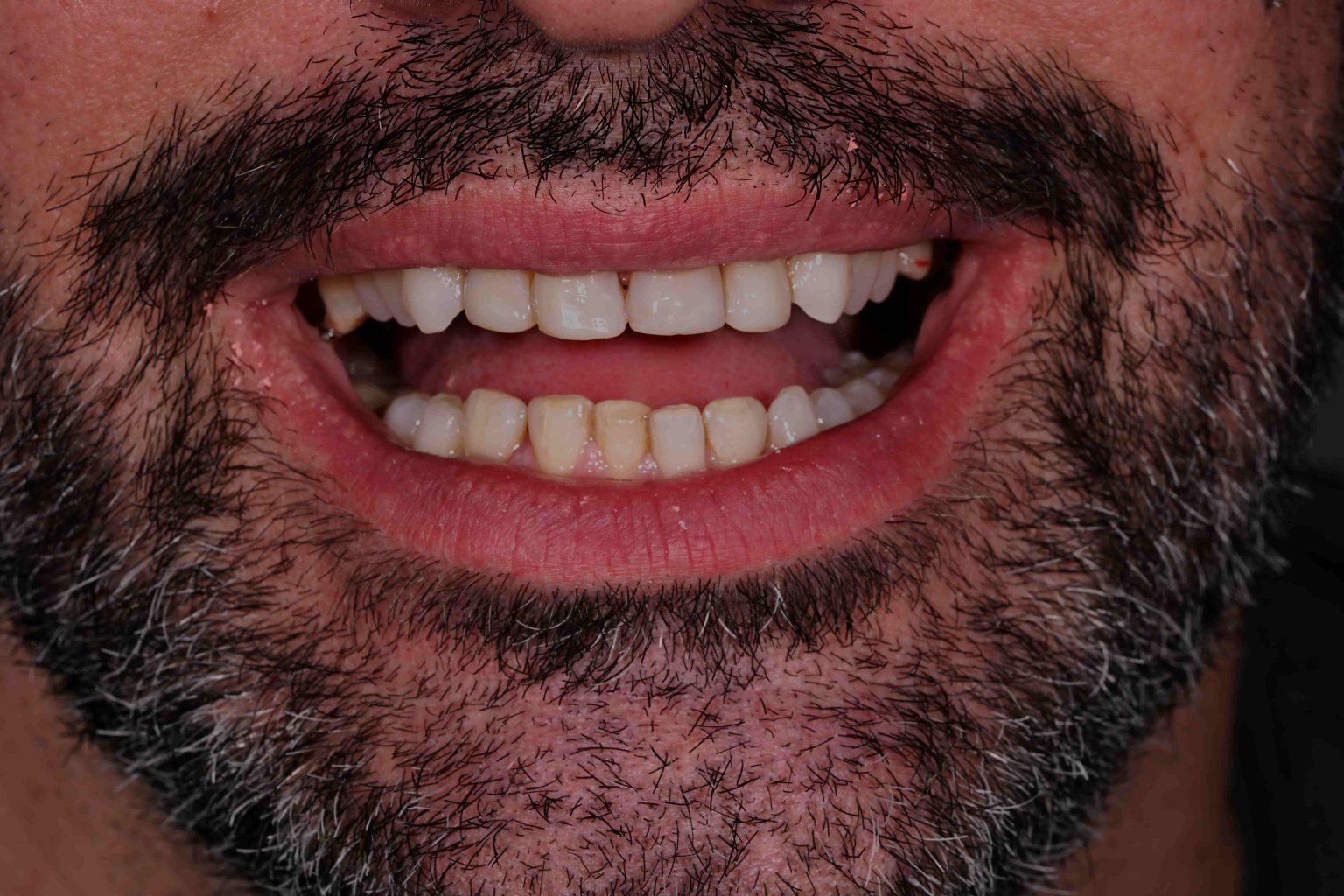 Ultra-thin super bleached composites veneers - Dental Aesthetics