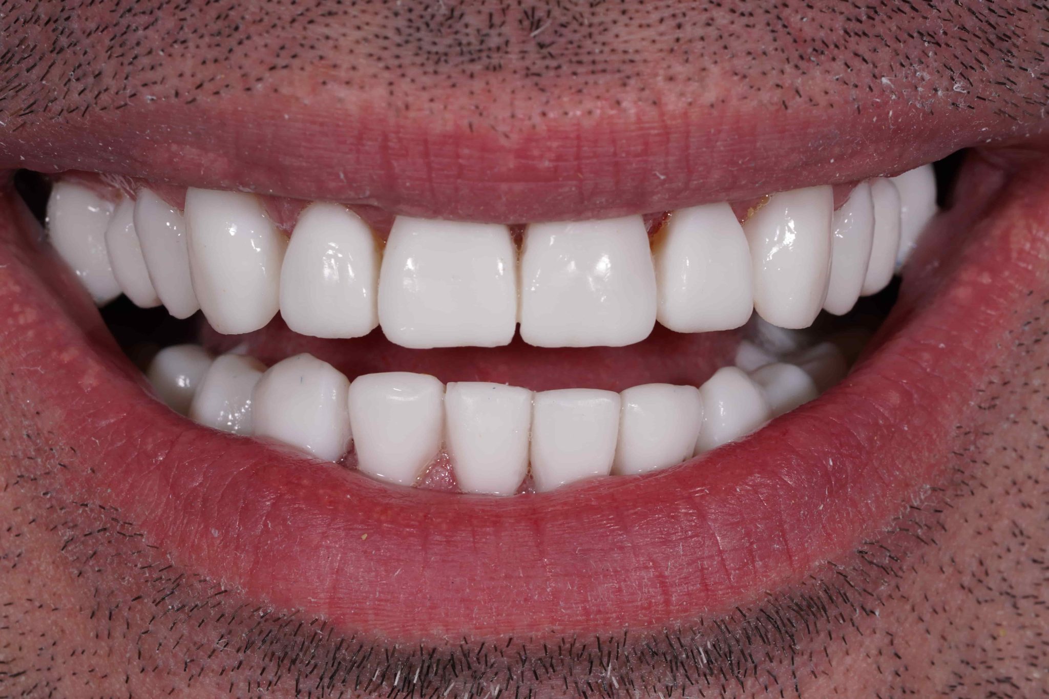 Ultra-thin super bleached composites veneers - Dental Aesthetics