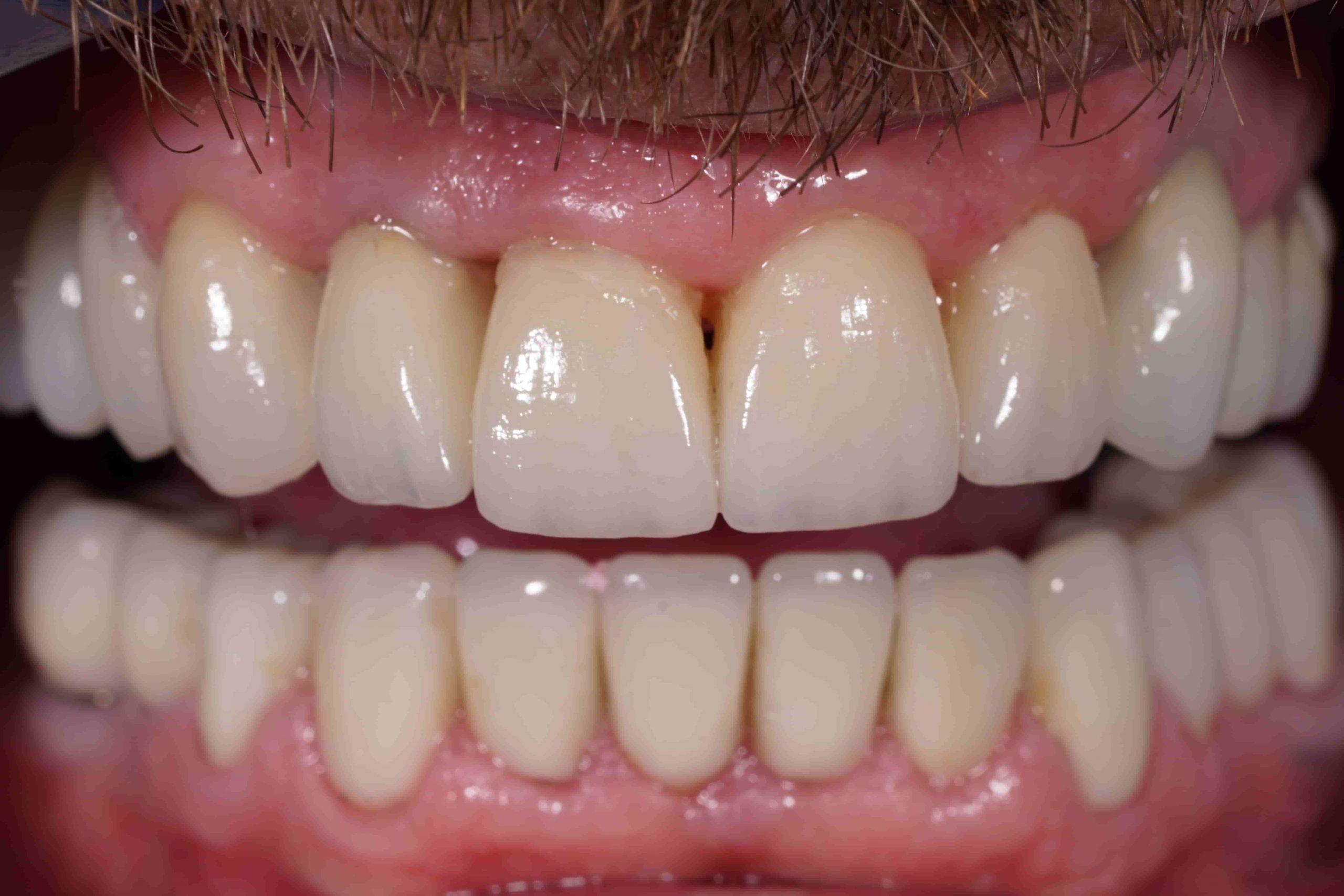 Complete prosthetic reconstruction with 360 veneers and implants ...