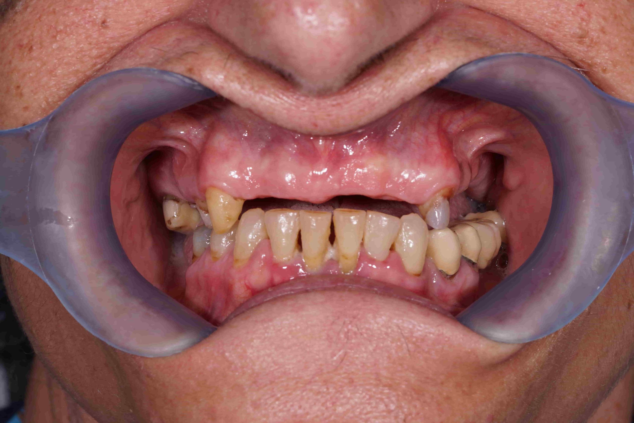 Κινητή προσθετική με οδοντοστοιχία - Dental Aesthetics