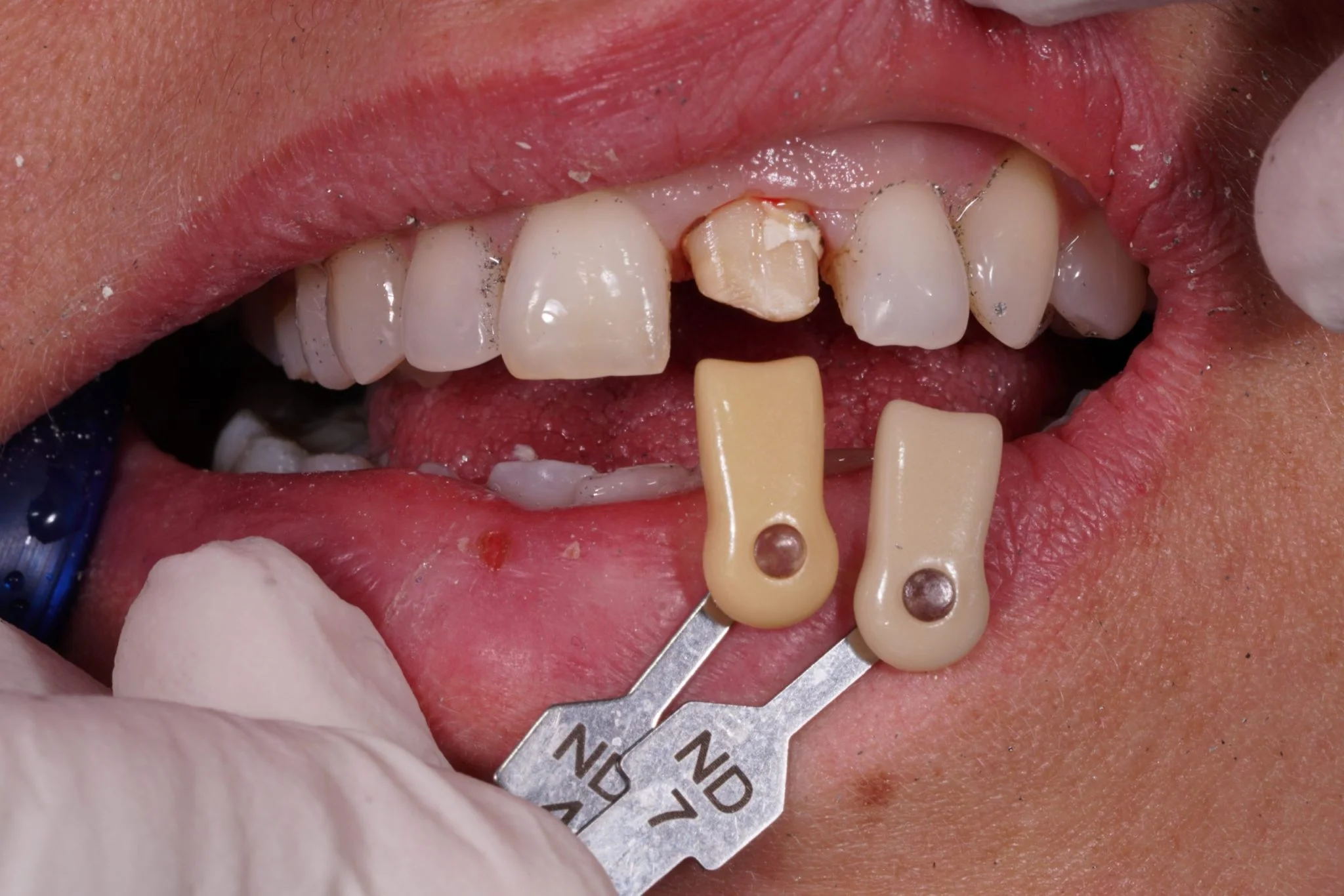 Single crown on upper front tooth – Challenging case - Dental Aesthetics
